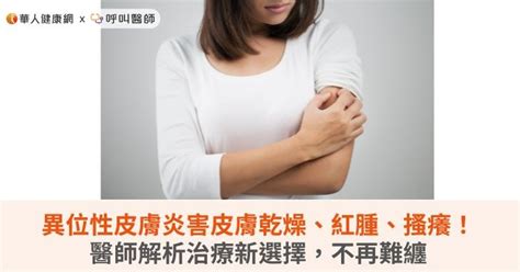 異位性皮膚炎害皮膚乾燥、紅腫、搔癢！醫師解析治療新選擇，不再難纏 蕃新聞