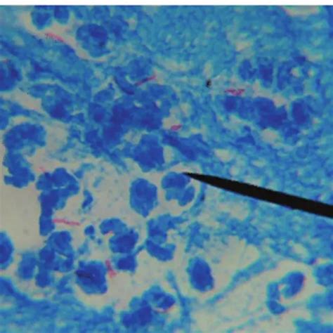 Sputum Acid Fast Bacillus Test Price In Delhi Ganesh Diagnostic