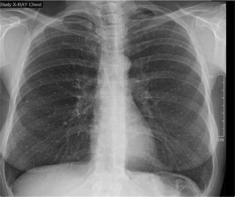 Chest Xray Bilateral Diffuse Micronodules Download Scientific Diagram