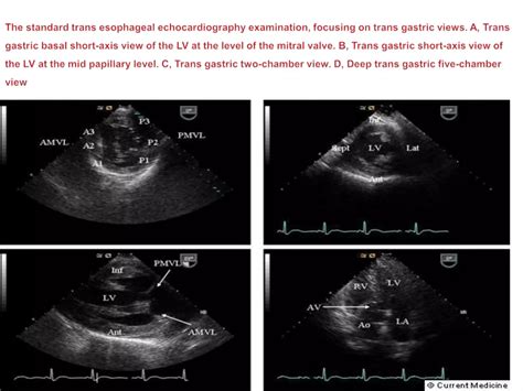 Transesophageal Echocardiographytee Ppt