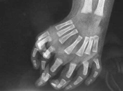 Radiograph Of Hand Shows Seven Triphalangeal Digits With Seven Download Scientific Diagram