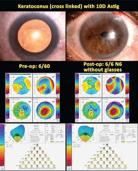 A Technique For Irregular Corneal Astigmatism