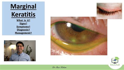 Marginal Keratitis