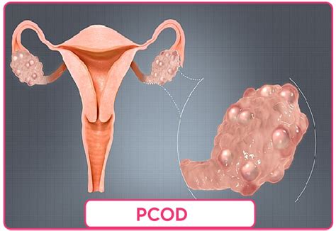 Pcod Treatment In Indore With Dr Varsha Mahajan