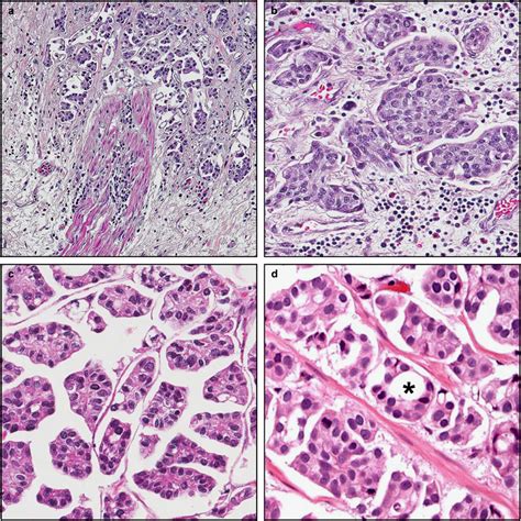 Update On Features Of Micropapillary Urothelial Carcinoma A