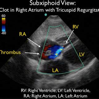 Subxiphoid Cardiac Echo View Demonstrated Thrombi Within The Right Download Scientific Diagram