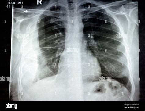 Plain X Ray For A Patient With Aspiration Pneumonia Right Lung Empyema