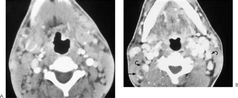 Enlarged Cervical Lymph Nodes In Patients With Acquired