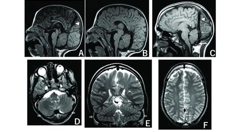 Persistent Falcine Sinus And Occipital Sinus In Case 2 A B Sagittal