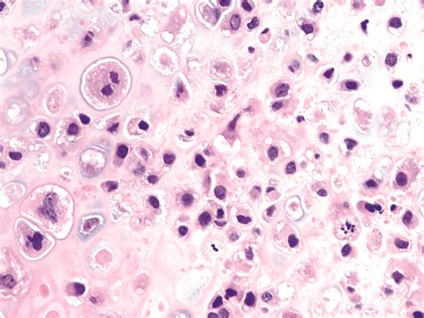 Pathology Outlines Chondrosarcoma Primary Secondary Periosteal