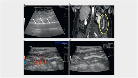 5 9 Year Old Patient With Left Sided Colitis Longitudinal Us Image
