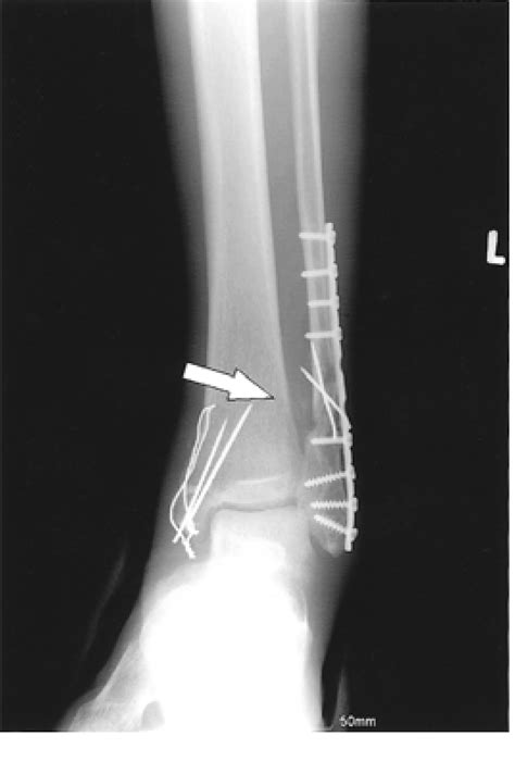 Figure 1 From Heterotopic Ossification Of Distal Tibiofibular Syndesmosis After Ankle Fractures