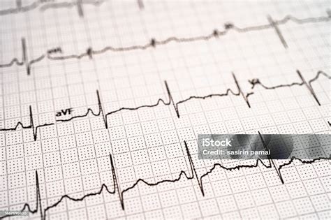Electrocardiogram Ecg Heart Wave Heart Attack Cardiogram Report Stock