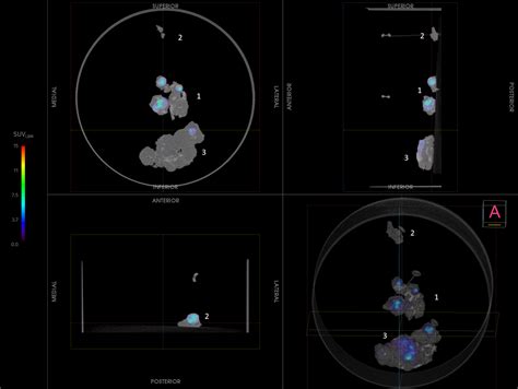 Imaging Case 28 Breast Cancer Invasive Lobular Carcinoma