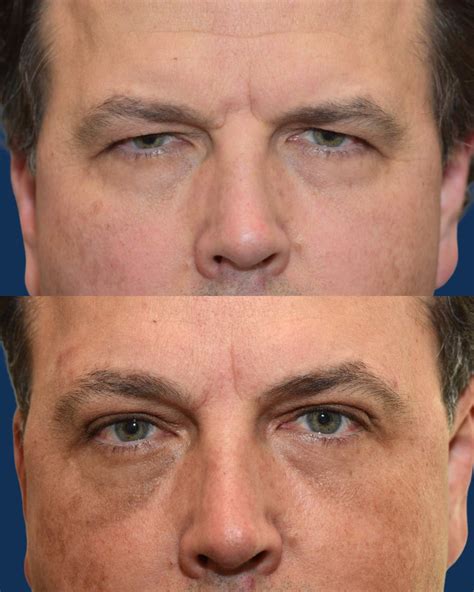 Lower Blepharoplasty Before And After Photos Morgenstern Clinic
