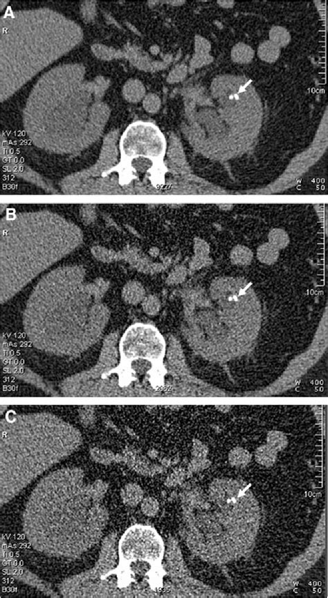 figure 1 from low dose computed tomography in the evaluation of