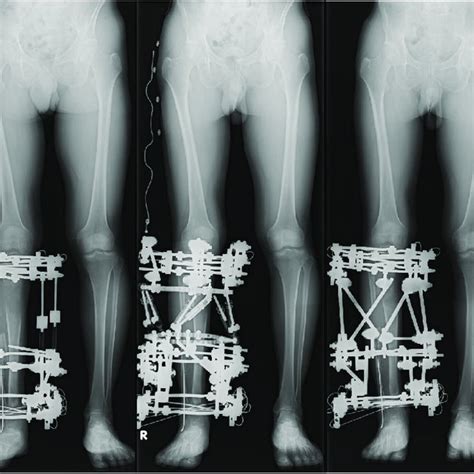A AP B Lateral Initial X Ray Shows Severe Comminuted Fractures In