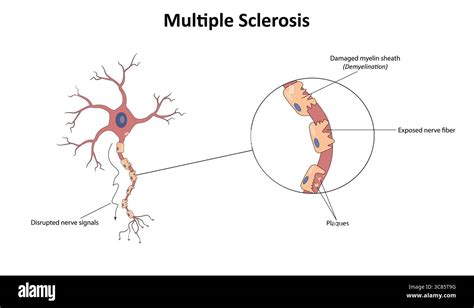 Multiple Sclerosis Vector Illustration Stock Vector Image And Art Alamy