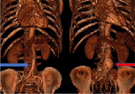 Radiological Image Of A Two Persons One Normal Aorta Blue Arrow And
