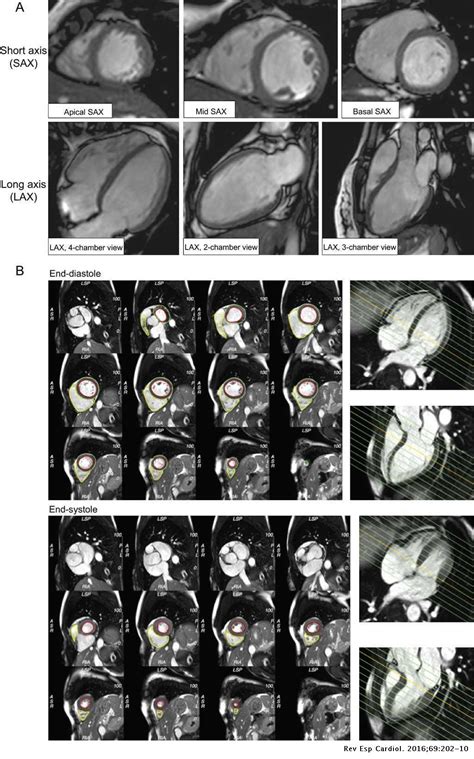Cardiovascular Magnetic Resonance In Cardiology Practice A Concise