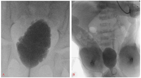 Catheter Neurogenic Bladder Dysfunction At Janie Clark Blog
