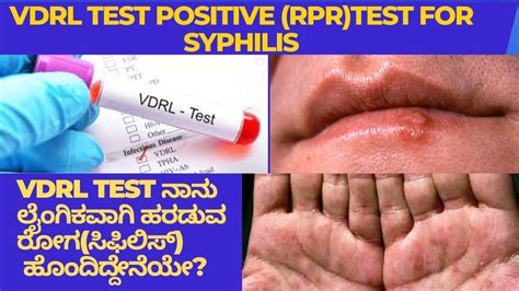 Vdrl Rpr Test For Syphilis Cost Procedure Indications False Positives Negetives Report In