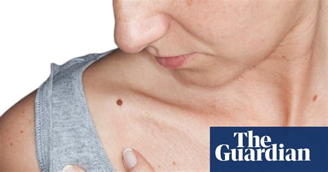 Signs And Symptoms Of Skin Cancer On The Scalp Cancerwalls