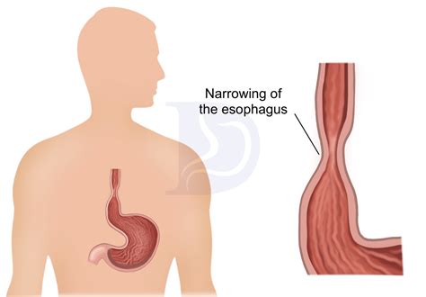 Esophageal Dilation Procedure Find Relief Today