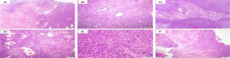 Ntrk Fusion Sarcoma Of The Uterine Cervix Report Of 2 Cases