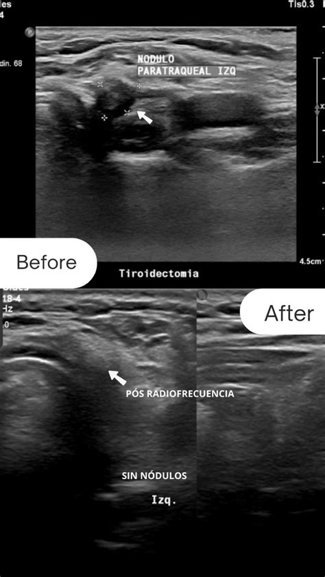 Radiofrequency Ablation For Thyroid Cancer Dra Monserrath Acosta