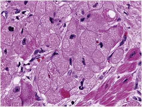 Restrictive Cardiomyopathy Histology