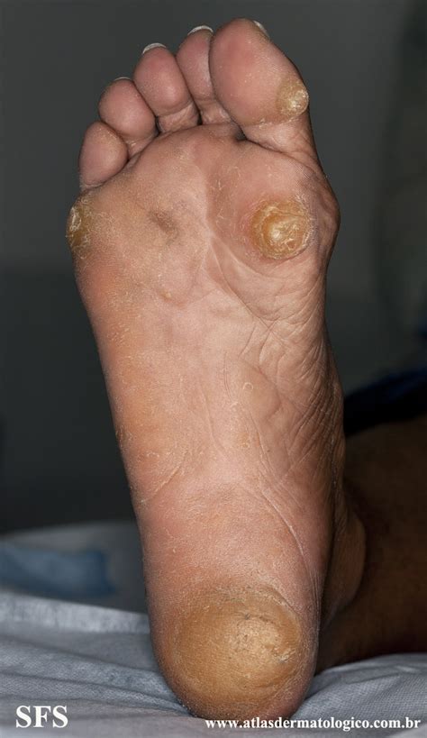 Palmoplantar Keratoderma Focal Keratoderma Nc Commons