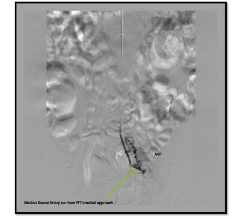 Spinal Angiogram Image This Was The Median Sacral Artery Run Done Via