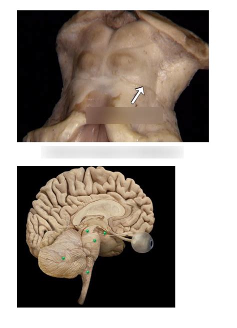 Cn Iv Trochlear Diagram Quizlet