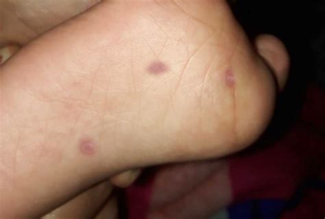 541 Kaso Ng Hand Foot And Mouth Disease Naitala Sa Albay BILIBB