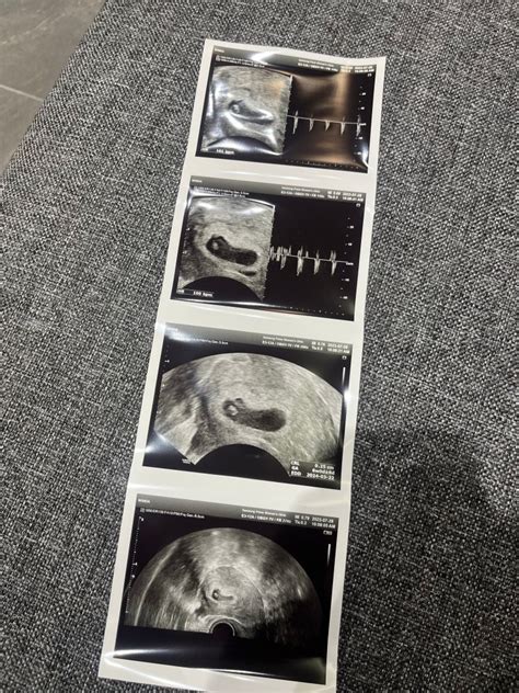 임신 6주차 난황 및 아기 지식in