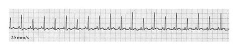 Electrocardiography Showing “electrical Alternans ” As Seen In Some