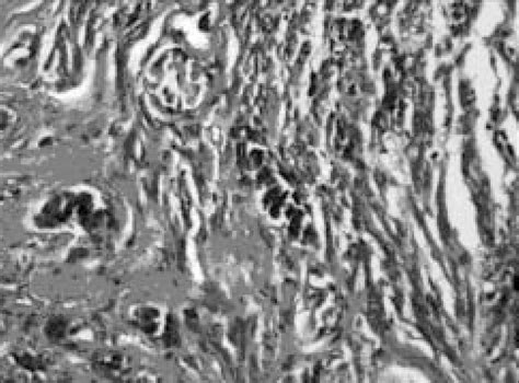 Carcinoid In Appendix Download Scientific Diagram