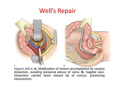 Rectal Prolapse Surgical Approaches Pptx
