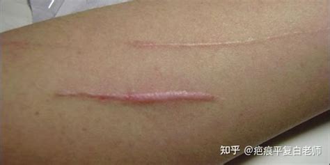 【科普】去手术疤痕的方法，不看后悔 知乎