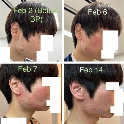 Is This Chemical Burndamaged Moistuire Barrieror Hyperpigmentation