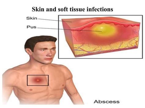 Cellulitis Ppt