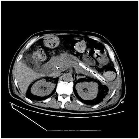 Computed Tomography Of The Abdomen After Necrosectomy Axial View Download Scientific Diagram