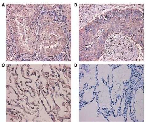 Immunohistochemical Staining Of Mmp 10 Mmp 10 Was Diffusely Expressed