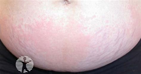 Polymorphic Eruption Of Pregnancy Image