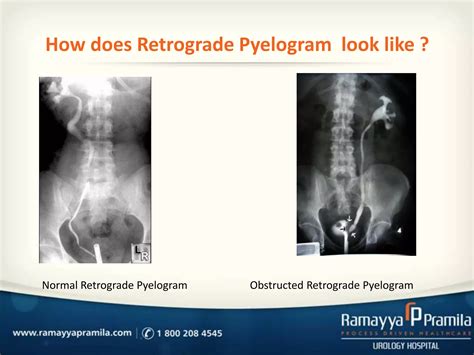 Antegrade And Retrograde Pyelography Pptx