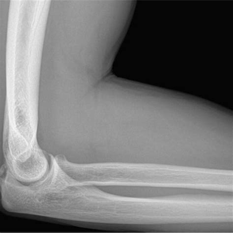 Sagittal View Mr Arthrogram Revealing Fragmented Posteromedial Download Scientific Diagram