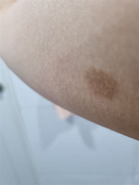 피부 변색 질문 답변 부탁드려요 지식in
