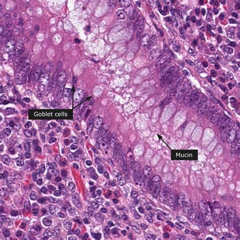 Appendix Histology Labeled Ab Appendix With Obstructive