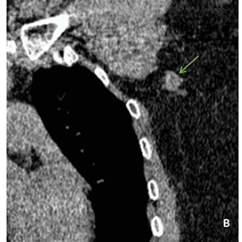 Contrast Enhanced 3d Frontal Mr Lymphography Maximum Intensity Download Scientific Diagram